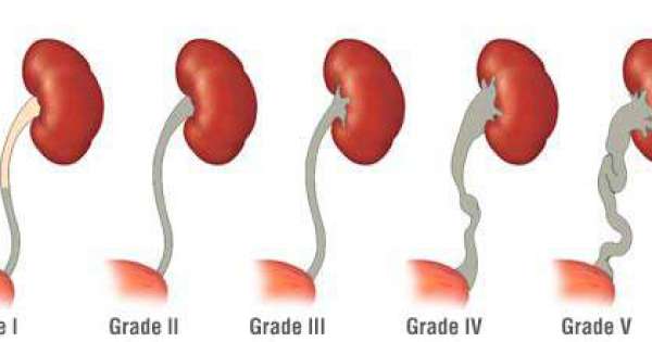 الارتجاع و الجذر البولي
